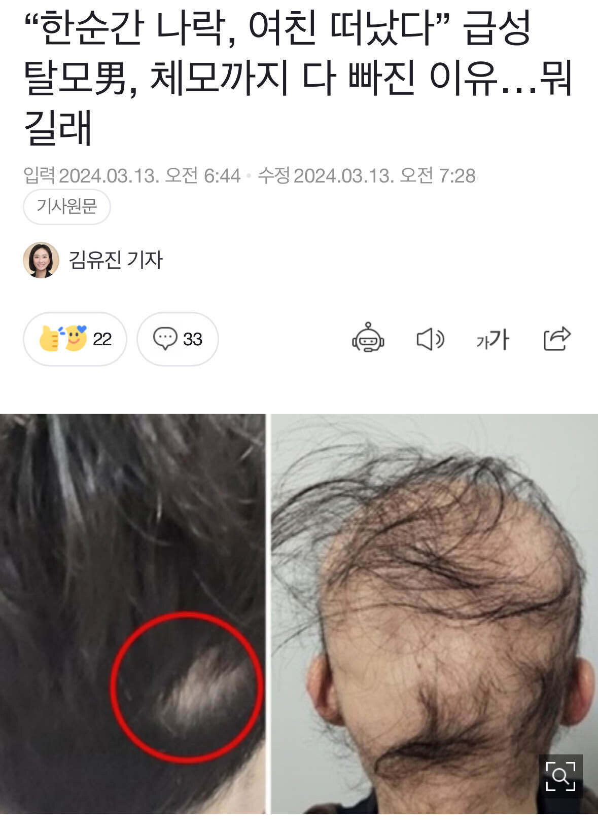 블라인드 | 썸·연애: 남친이 탈모로 머머리가 된다면